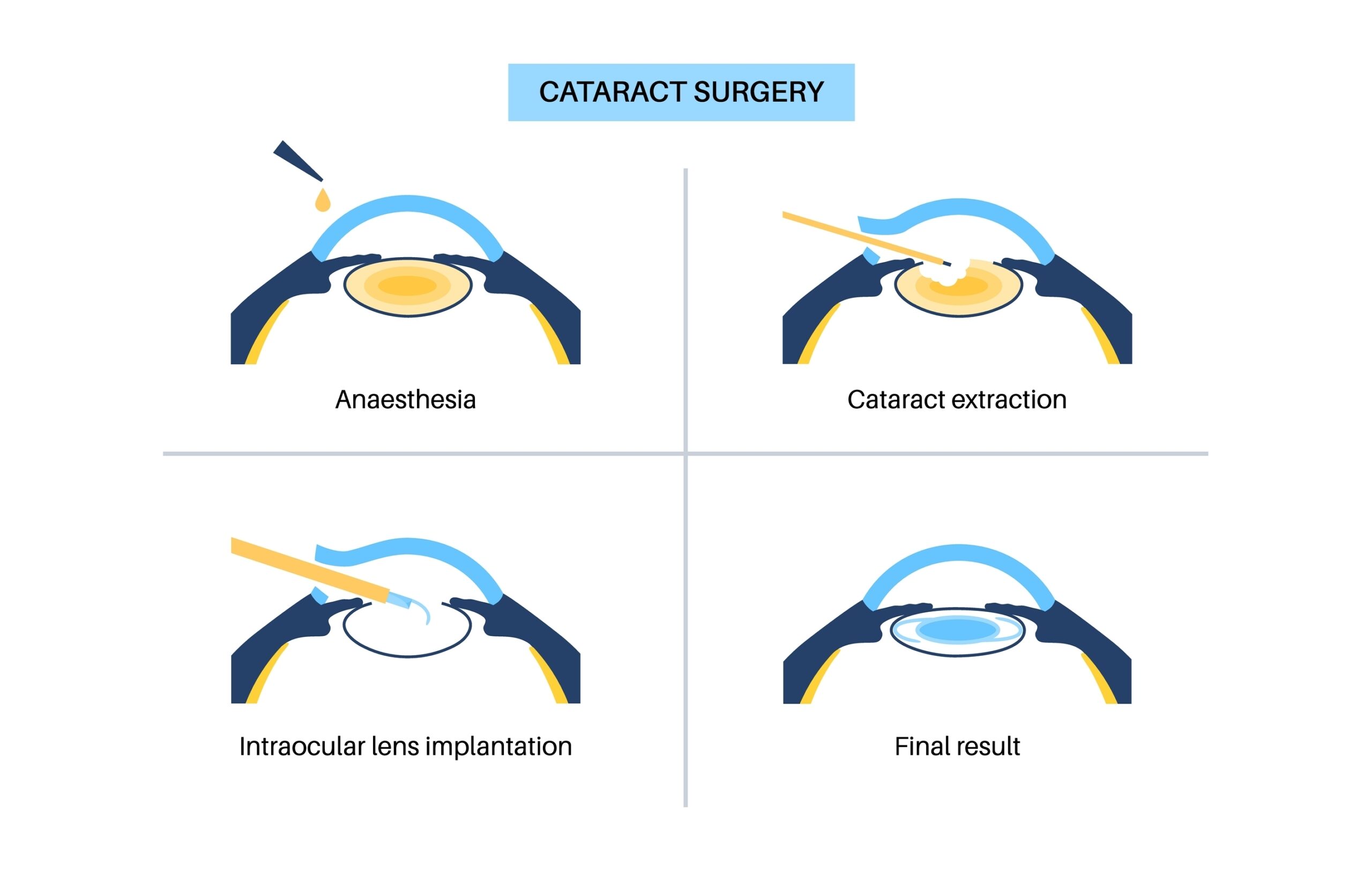 Is a Toric Lens the Solution for Astigmatism in Cataract Surgery ...